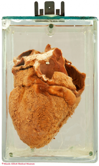 10 Heart Pericarditis Maude Abbott Medical Museum Mcgill University