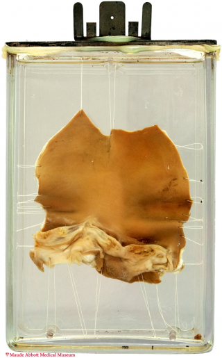 20 Heart Acute Infective Endocarditis Maude Abbott Medical Museum